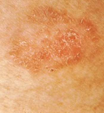 Squamous Cell Carcinoma - Richmond Dermatology