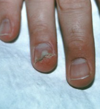 Squamous Cell Carcinoma - Richmond Dermatology